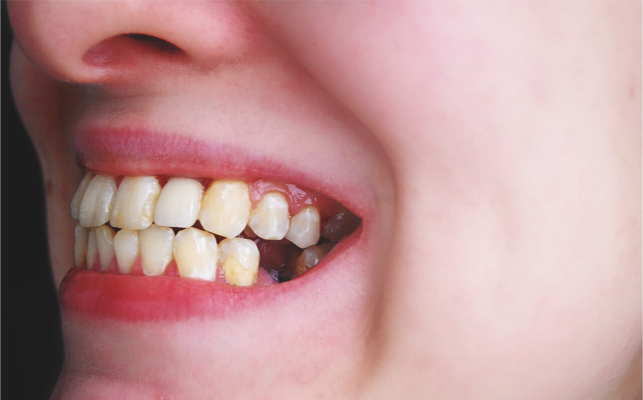 Tooth implant for missing side tooth | ifpafederation.org