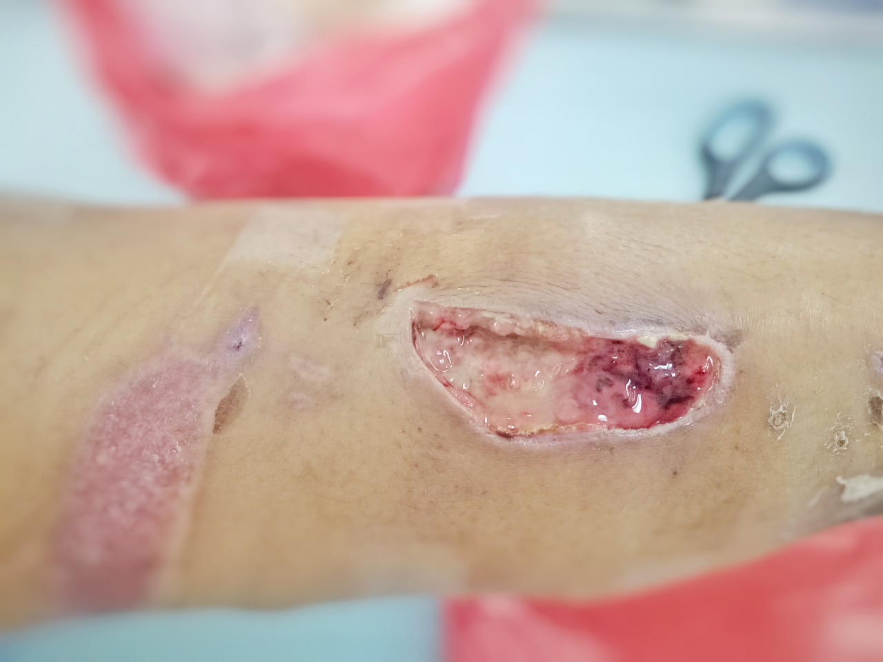 Tissue Expander Used For Tissue Expansion - IFPAFederation.org