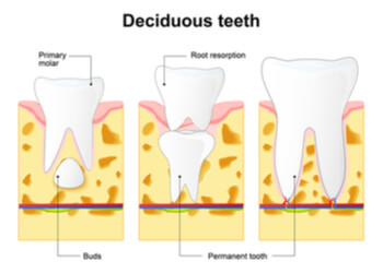 Tooth root resorption: what you need to know- IFPA federation